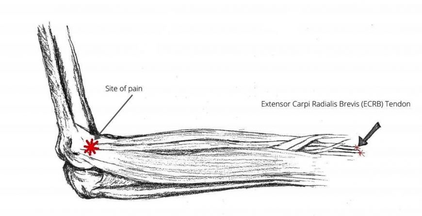 Common Conditions | Tennis Elbow | Specialised Hand Therapy